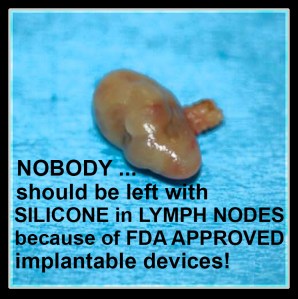 NOBODY … should have silicone in lymph nodes from FDA approved implantable devices! | Breast ...